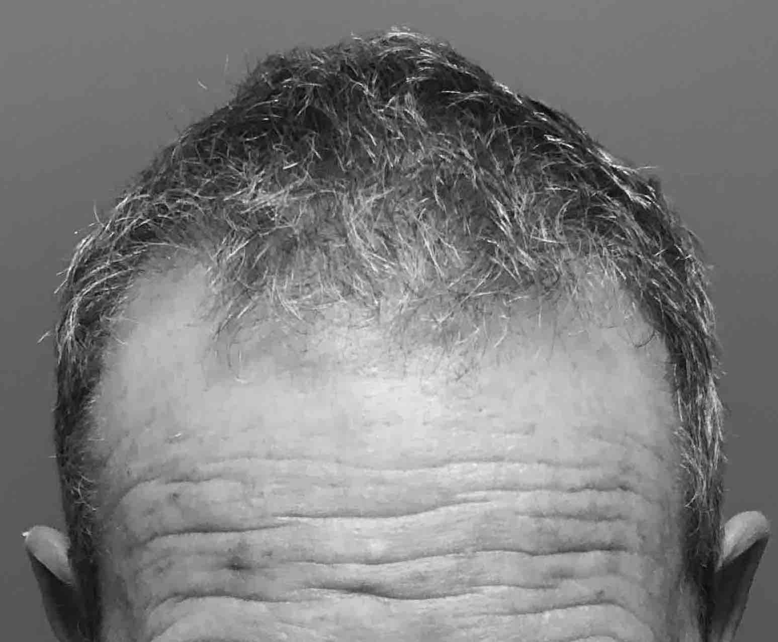 Dr Pascal Guigui spécialiste français de la greffe de cheveux